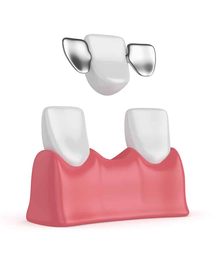 Pont dentaire | Centre dentaire Stéphane Girard à St-Jérôme